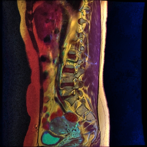 Nevit's blog: Color MRI of the Lumbar spine with extruded disc