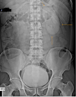Pemeriksaan Radiologi BNO pada suspect Pielonefritis akut - Seputar ...