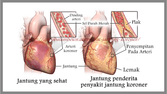 Penyakit Jantung Koroner, Penyebab, Gejala dan Cara Pengobatannya – IPA GEEK