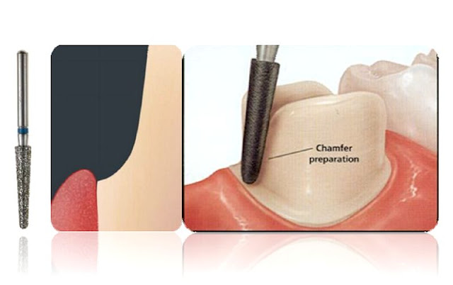 CHAMFER FINISHING LINE: Finishing line of the preparation