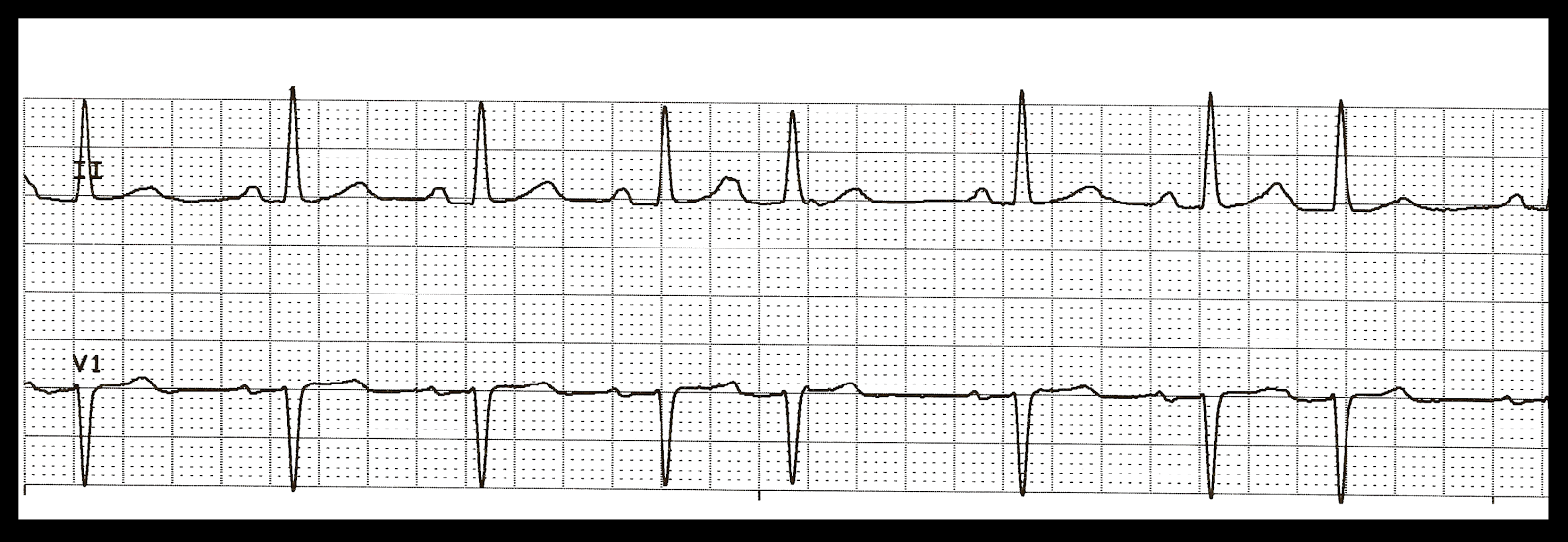Various Rhythms with PACs