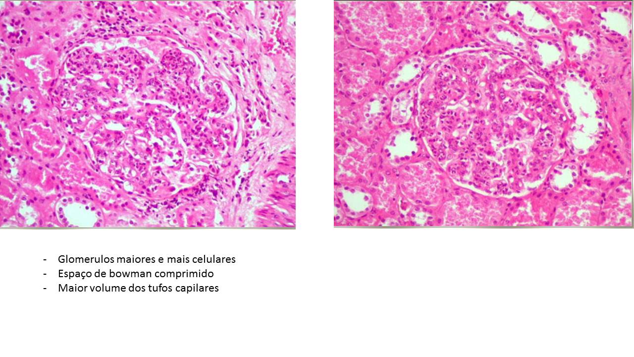 HISTOLOGIA90: RIM NORMAL E GLOMERULONEFRITES