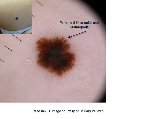 Dermoscopy Features as Clues: Lines radial peripheral or segmental ...