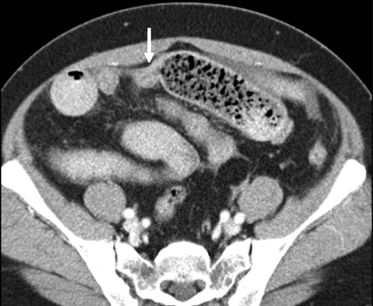 松下 ER ランチ・カンファレンス: Small bowel feces sign