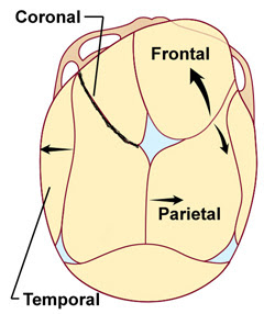 Oh, Boy!: craniosynostosis story