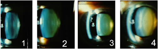 Ophthalmology Notes: Grading of nucleus hardness on slit-lamp biomicroscopy