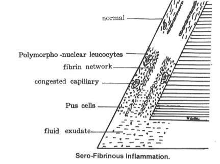 Inflammation ( part 4) l General pathology revision for dental student ...