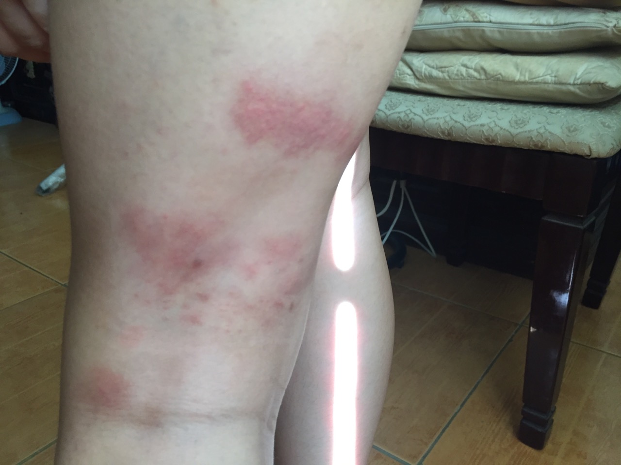 Dropped like a Hatputito: Experience | Bites Turned Into Rashes?