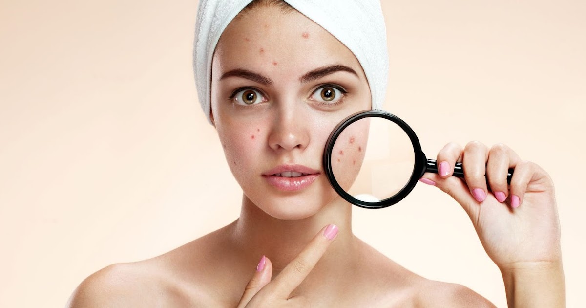 Pyoderma Faciale Definition, Symptoms, Causes, Treatment