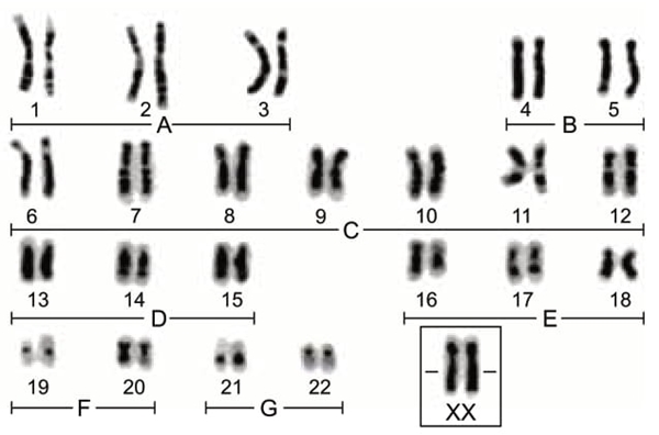 FAMEMA 2018: O cariograma a seguir foi obtido a partir do linfócito de ...