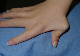 The Thumb in Arthrogryposis | Congenital Hand and Arm Differences ...