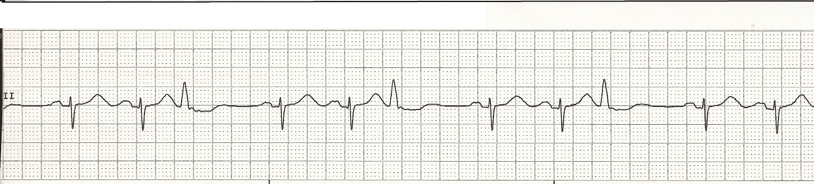 EKG Rhythm Strip Quiz 42