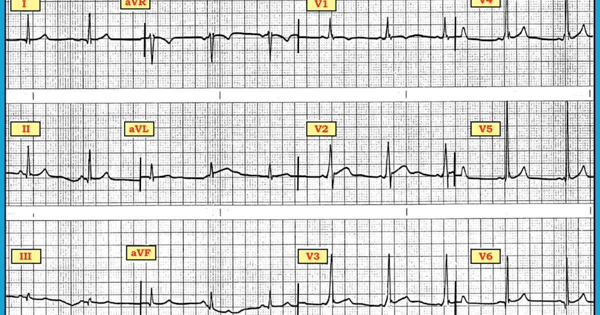 ECG Interpretation: ECG Blog #153 (LVH – RVH – WPW – RBBB)