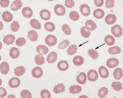 Atlas de Hematología : Equinocitos.