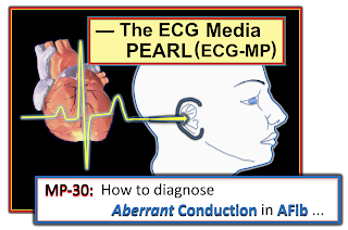 ECG Interpretation: ECG Blog #213 (ECG MP-30) — Aberrant Conduction ...