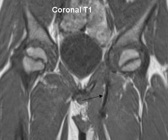 mricases: Perineal injury - Foreign body in the obturator externus ...