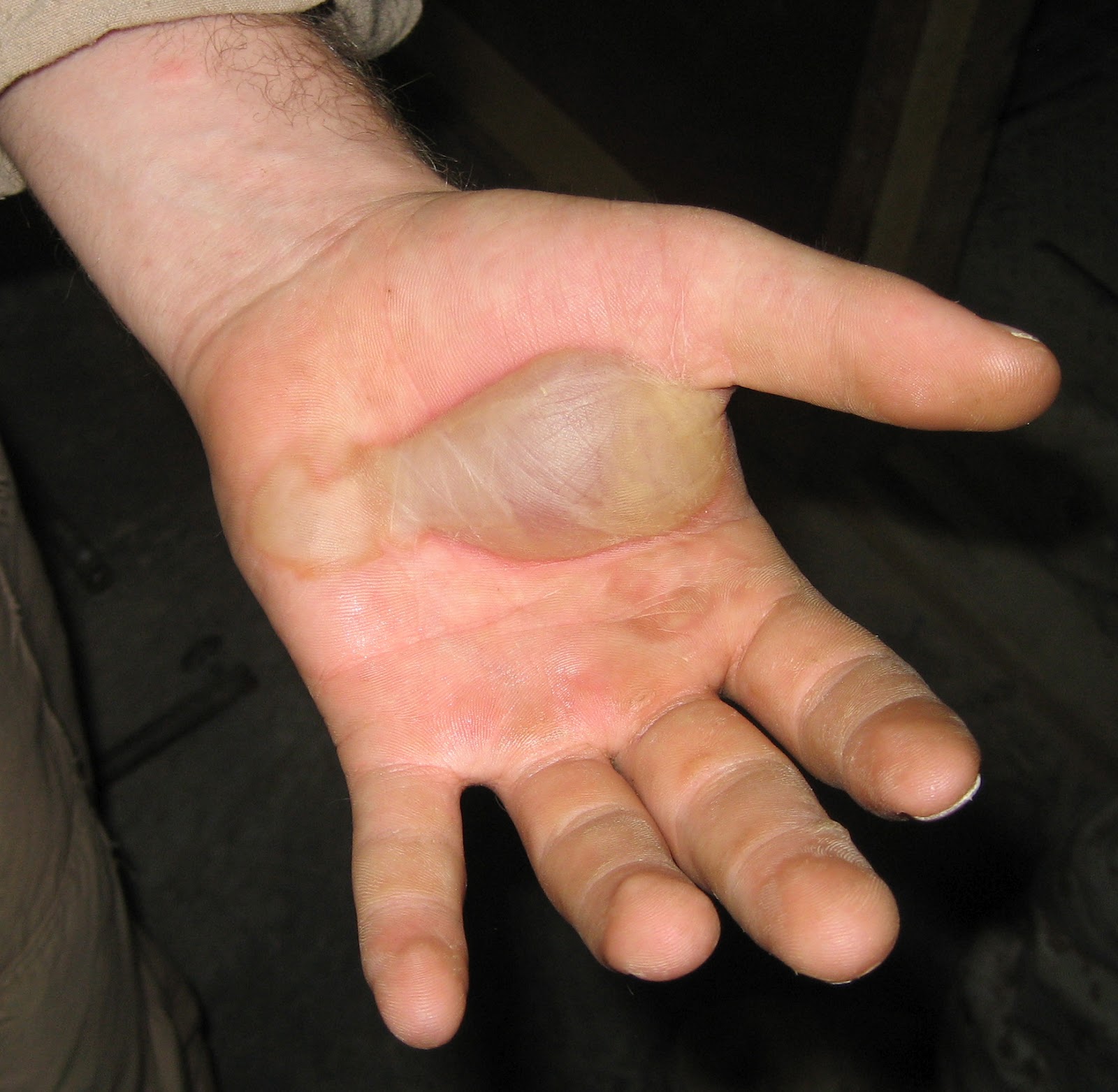 Deformutilation: Forensic Hand Trauma