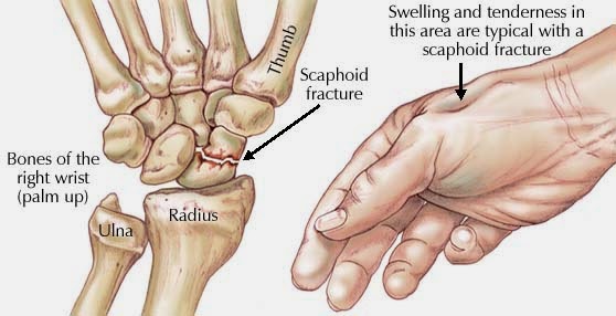 HAND AND WRIST SURGERY - Dr Narender Saini : Scaphoid bone fracture in ...