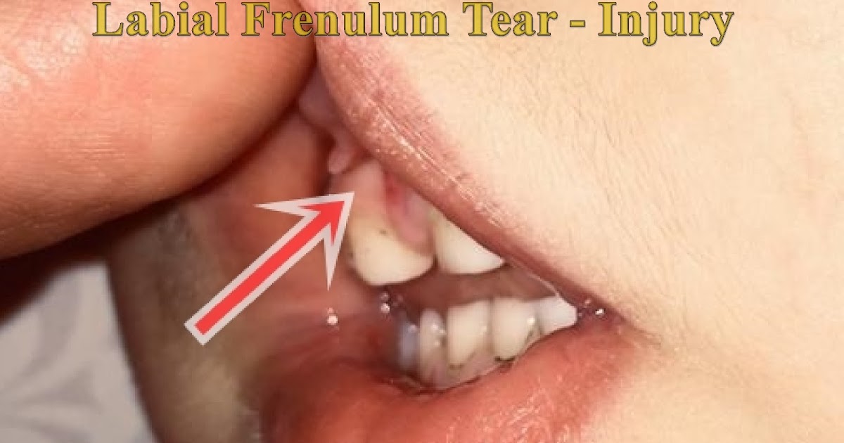 Labial Frenulum Laceration