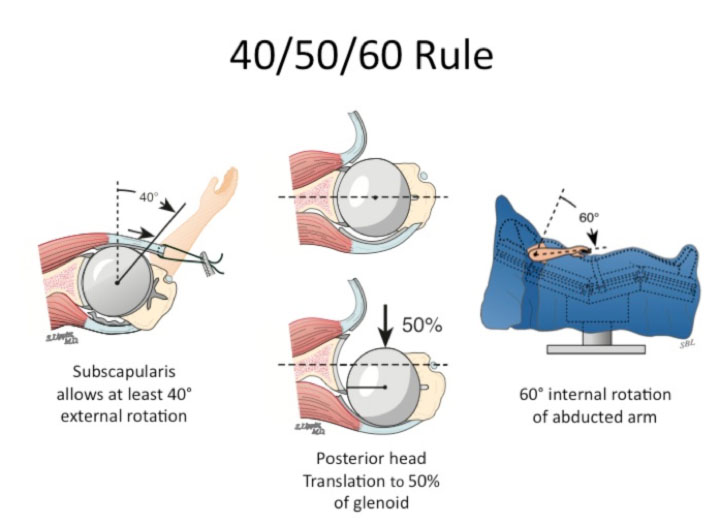 UW Shoulder and Elbow Academy: Shoulder joint replacement step by step ...