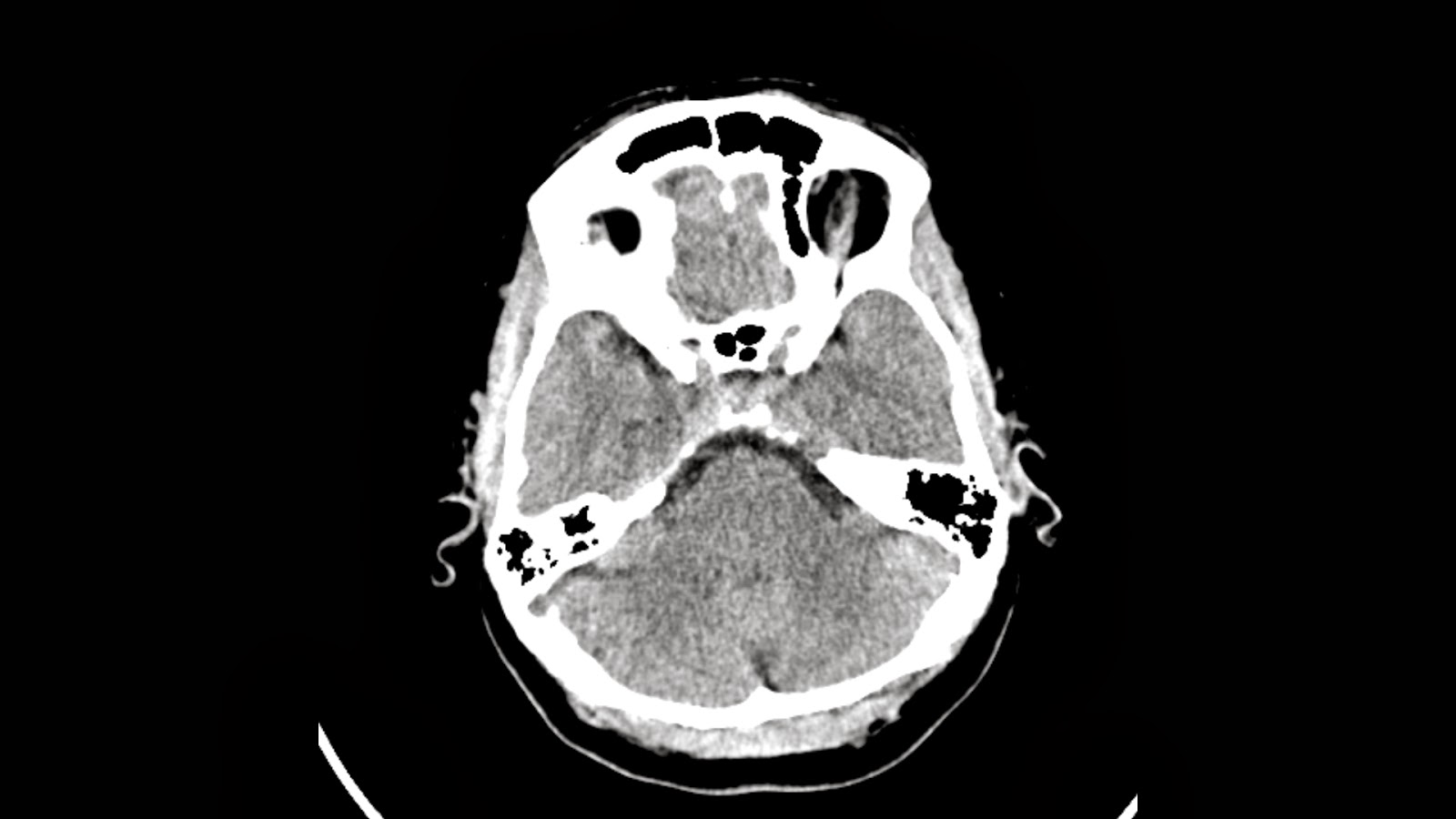 Ultimate Radiology : Fetal PCA