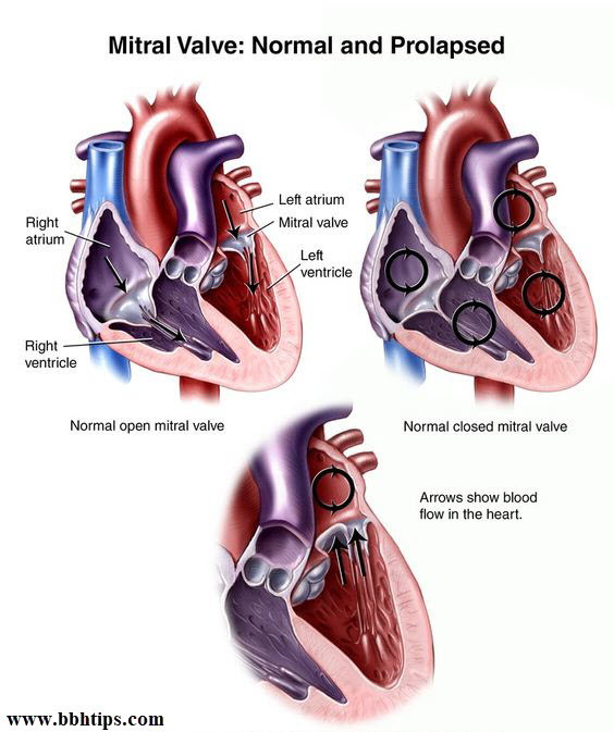 Heart Valve Disease Symptoms and Causes Tips - Best Beauty and Health Tips