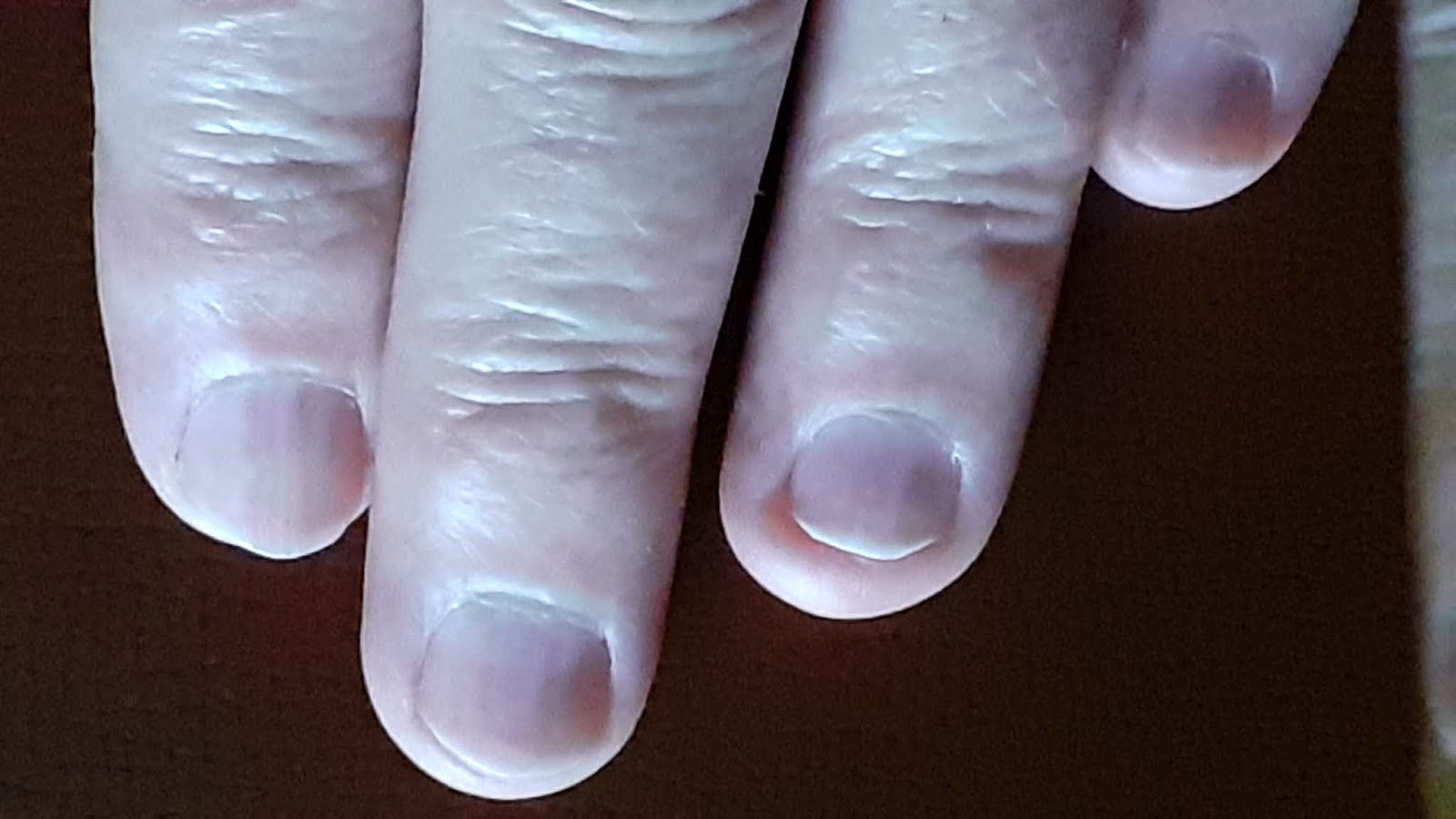 Personal Touch Works: Recovery from a ripped off finger nail