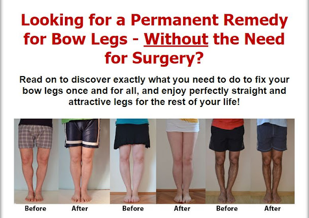 A Natural Focus To Bow Legs Treatments