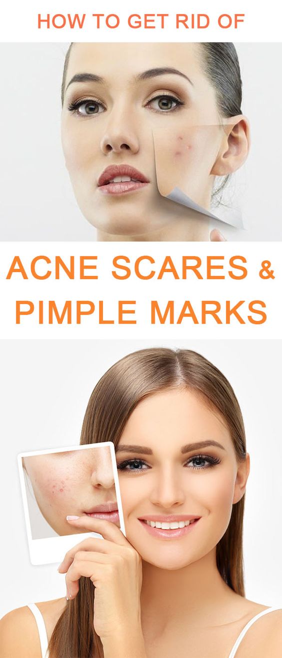 How To Get Rid Of Pimple Marks - TOP 5 DIY