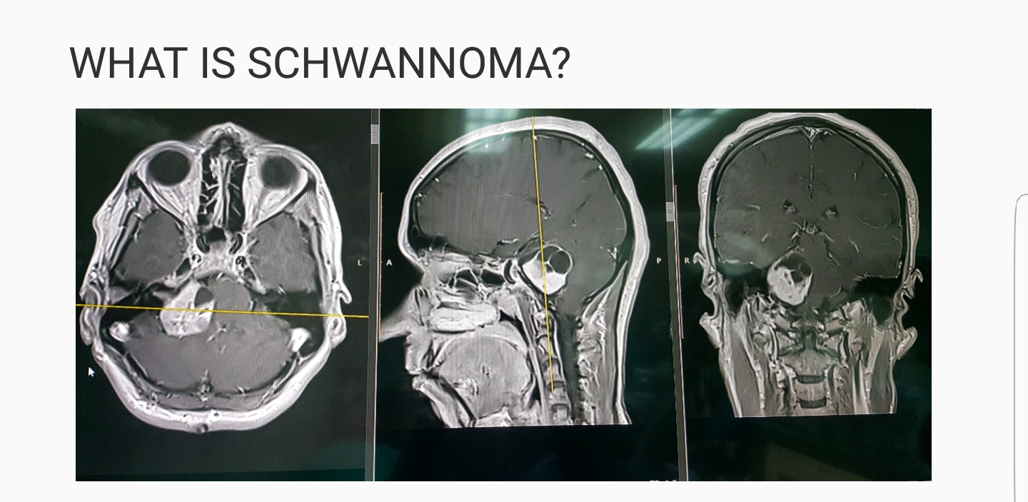 Alain Wambe, MD: What is schwannoma?