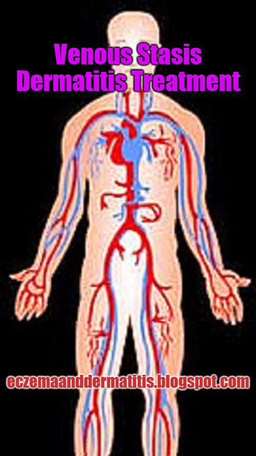 Venous Stasis Dermatitis Treatment - Eczema and Dermatitis