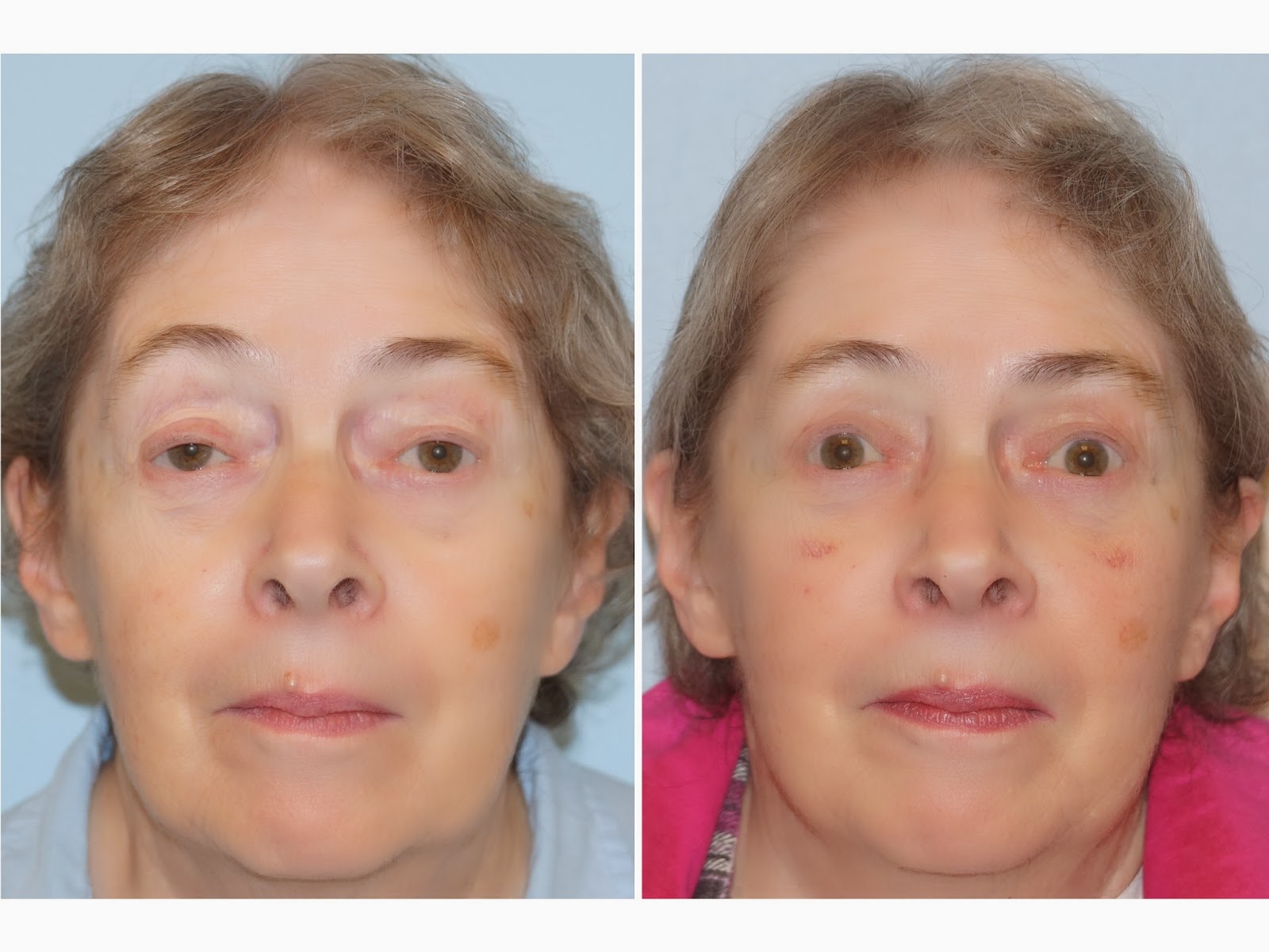Facial Plastic Surgery Lazy Eye Ptosis Repair Upper Blepharoplasty facial-plastic-surgery-lazy-eye-ptosis-repair-upper-blepharoplasty