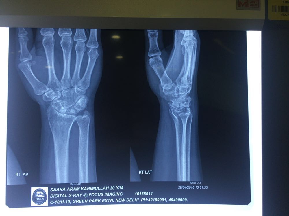 proximal row carpectomy