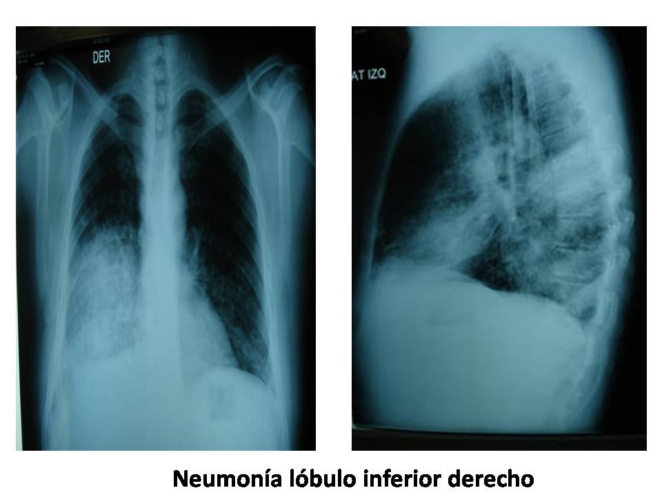 Neumonía adquirida en la comunidad (NAC)