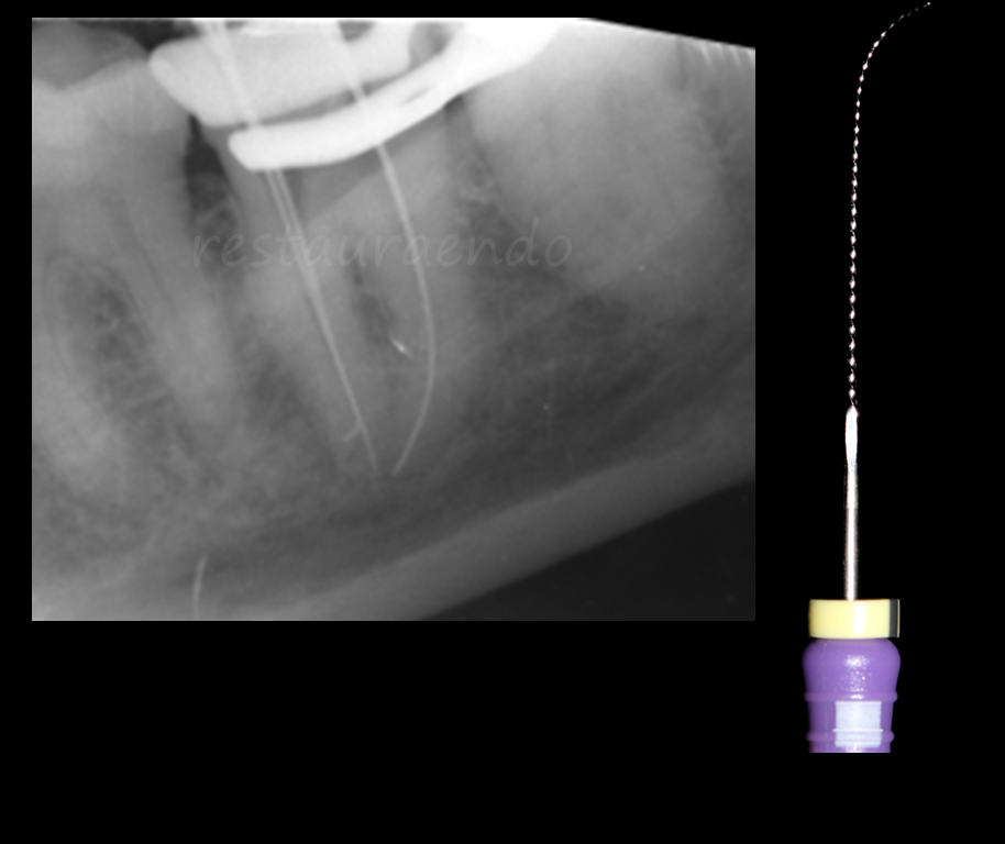 Máster en Odontología Restauradora y Endodoncia: Instrumentación y ...