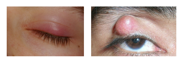 How to Get Rid of a Stye Fast: How to Get Rid of a Stye Fast?