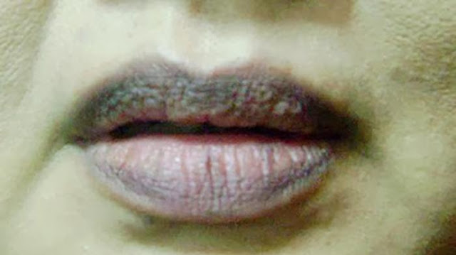 bibir hitam tanda penyakit apa - GunnertaroKnight