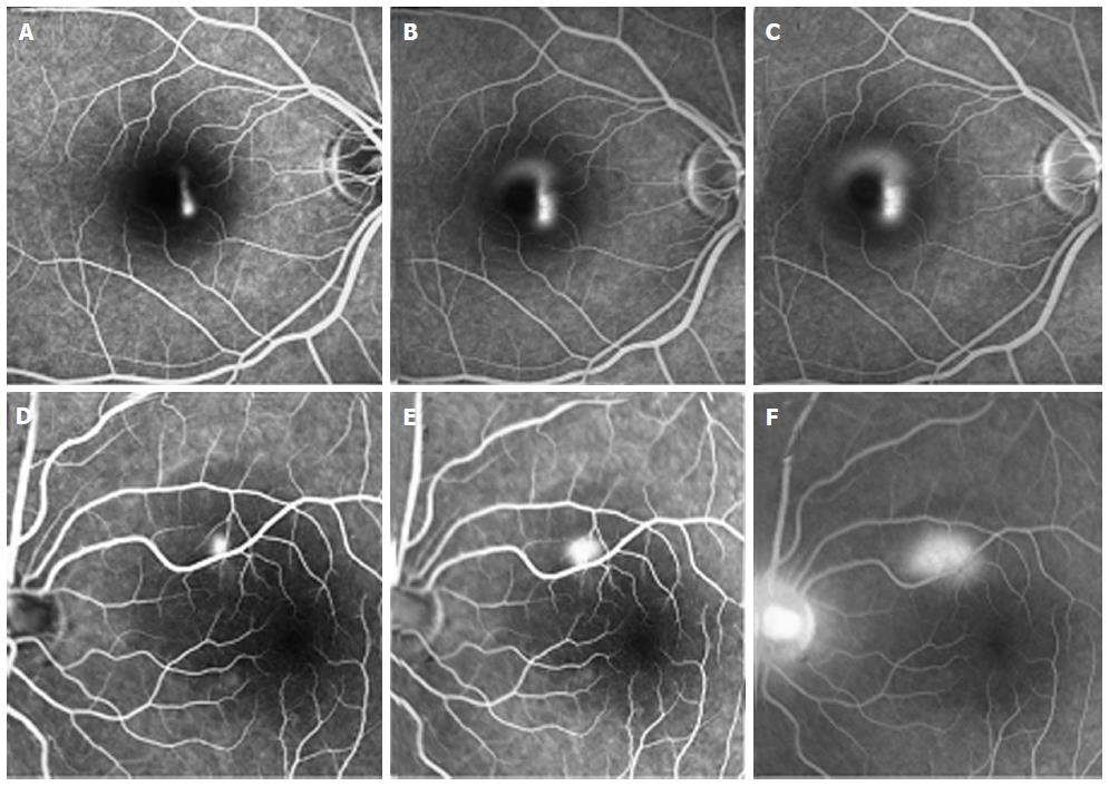 Ophthalmology Notes: CENTRAL SEROUS CHORIORETINOPATHY