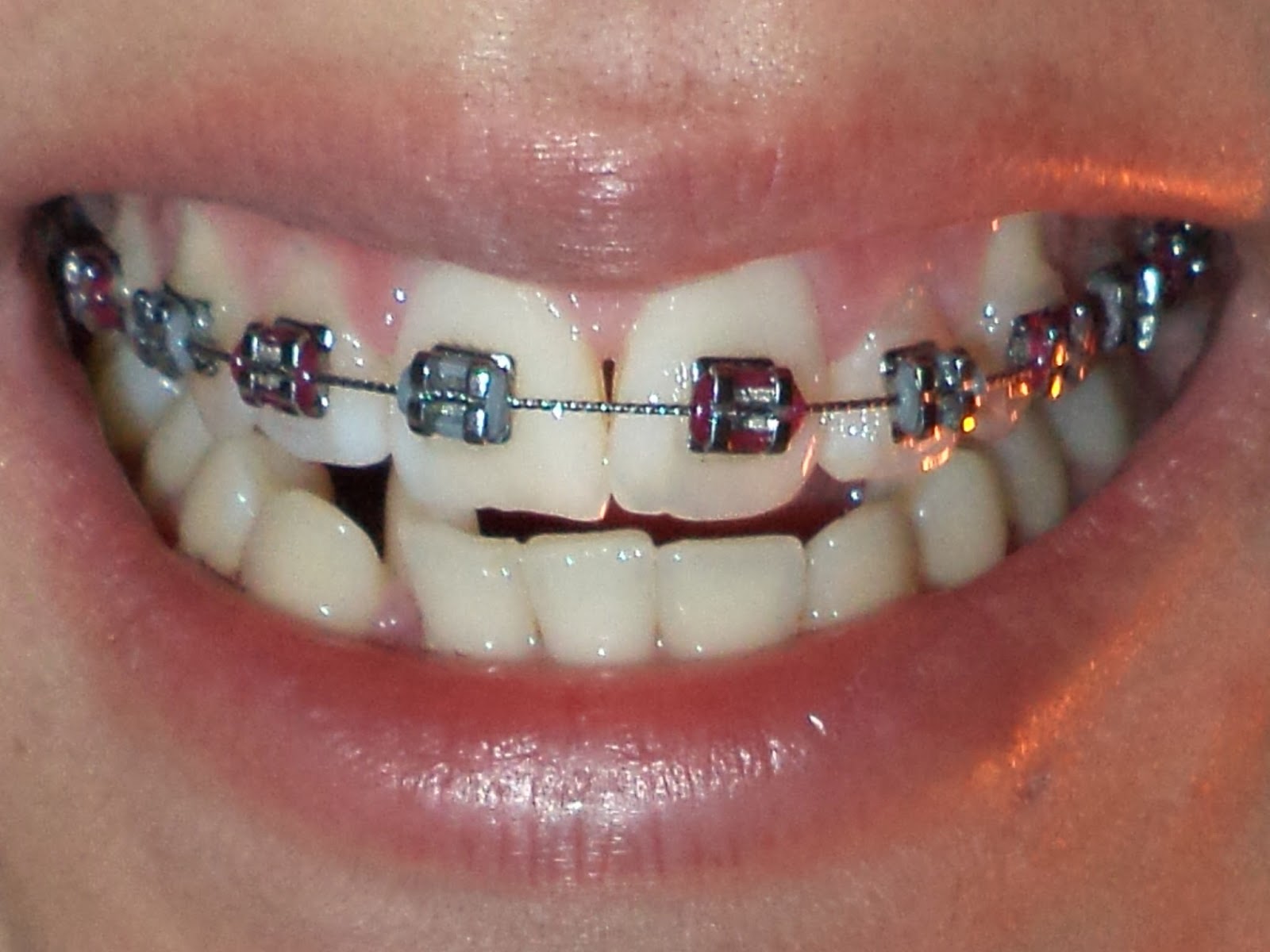 Mis Brackets: Paso a Paso [Mi experiencia]: 27-05-2014 - Cambio de Ligas