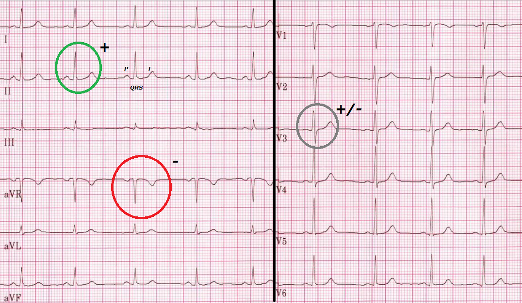 Stayin' Alive: Electrocardiograma: ¿Cómo interpretarlo? Parte I.
