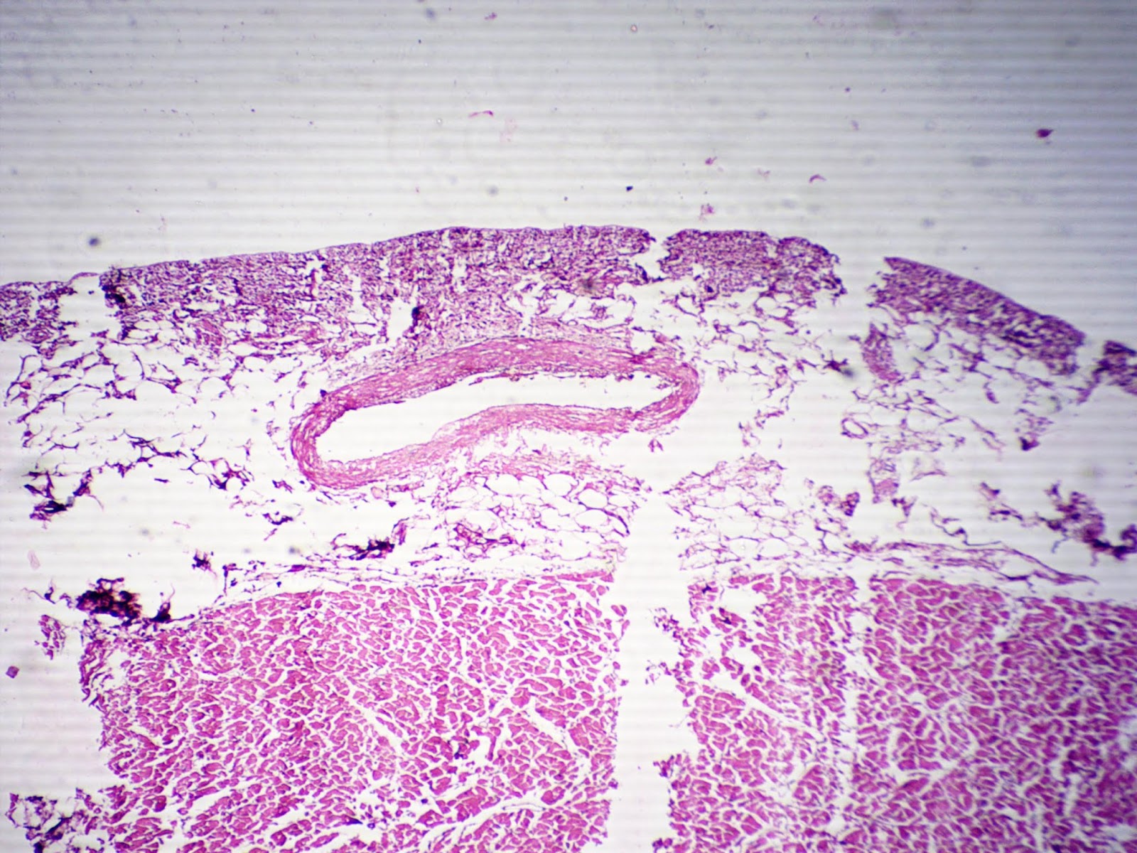 into the roots: Pericarditis