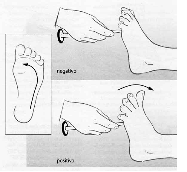 Reflejo de babinski; Respuesta del Extensor Plantar; Reflejo ...