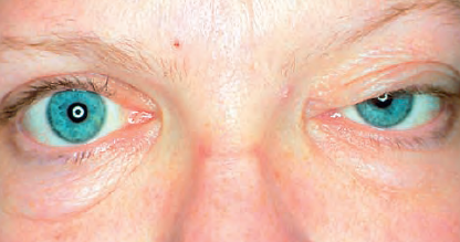 Blepharochalasis ! Eyelid imbrication syndrome ! Lower lid retraction
