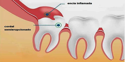 ¿Qué es la Pericoronitis? - OdontoVida