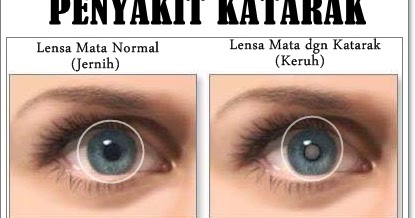 Pulihkan Penyakit Katarak Tanpa Pembedahan Elak Mata Menjadi Buta