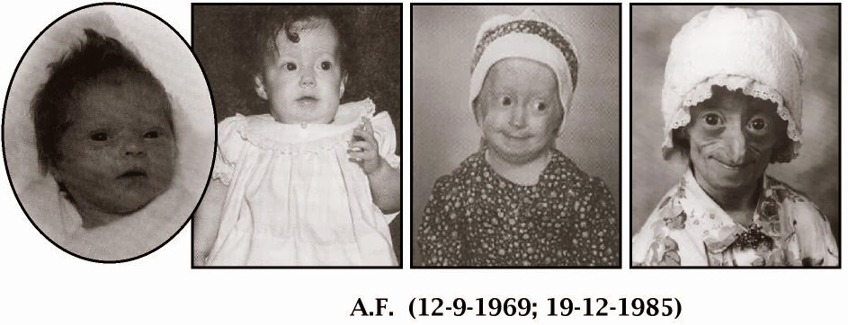 ENVEJECIMIENTO PRECOZ - ENFERMEDADES RARAS : LA PROGERIA O EL SINDROME ...