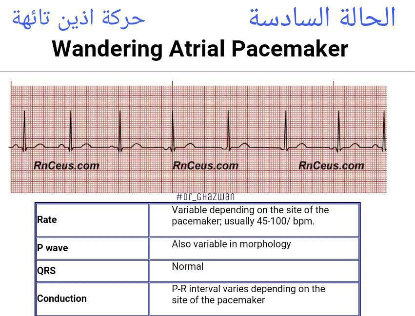 شرح تخطيط القلب الكهربائي Ecg وتحديد الحالة من رسم القلب
