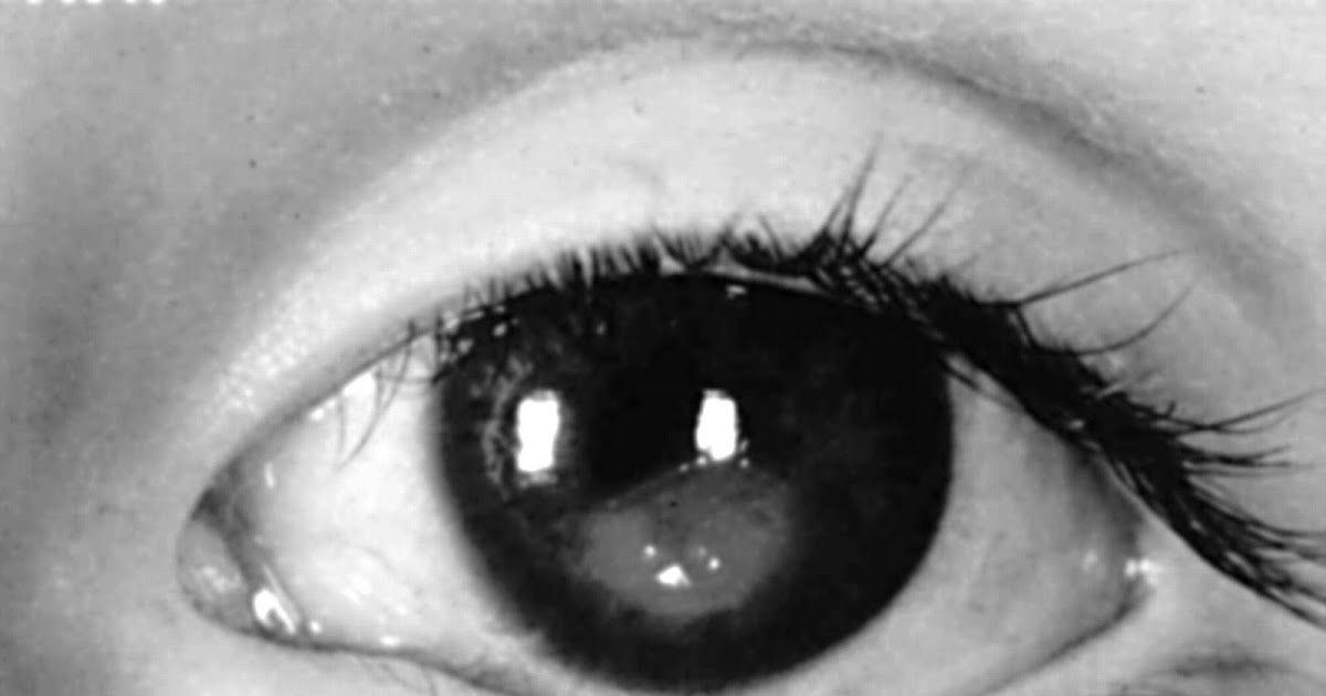 AMBITIOUS MEDICAL TEAM: Ulkus Kornea