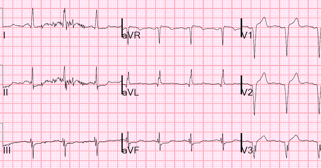 Dr. Smith's ECG Blog: 30-something with chest pain, a fragmented QRS ...
