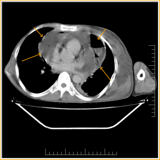 Pneumopericardium: CXR - Sumer's Radiology Blog